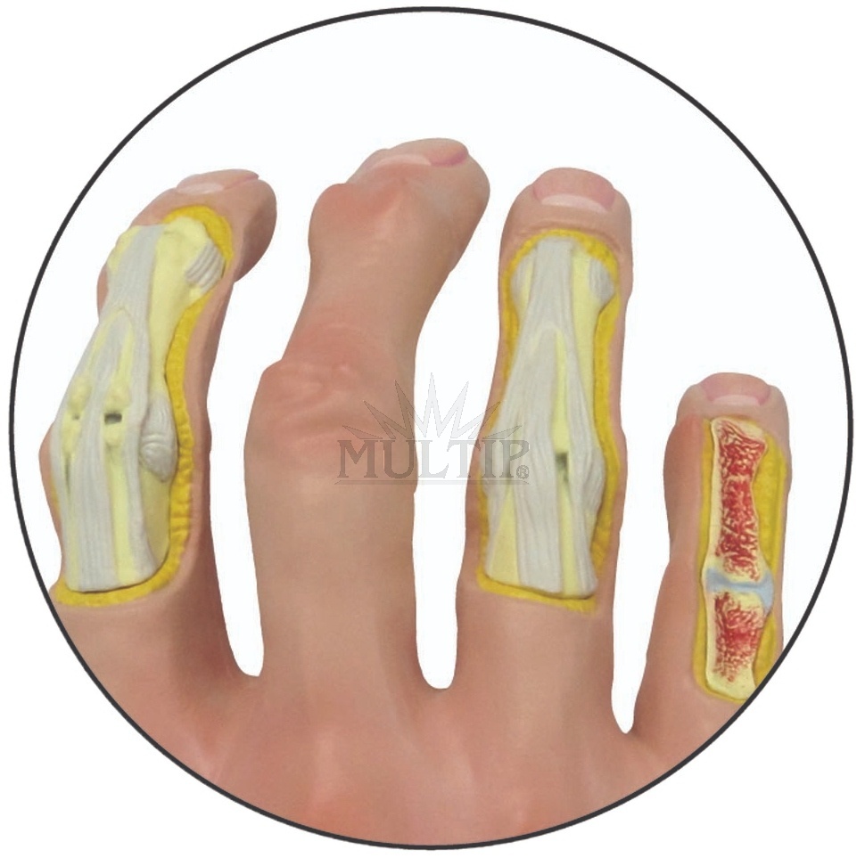 Osteoartróza - model ruky